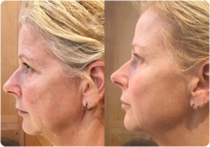 Face Exercises and Pilates - FaceToned®